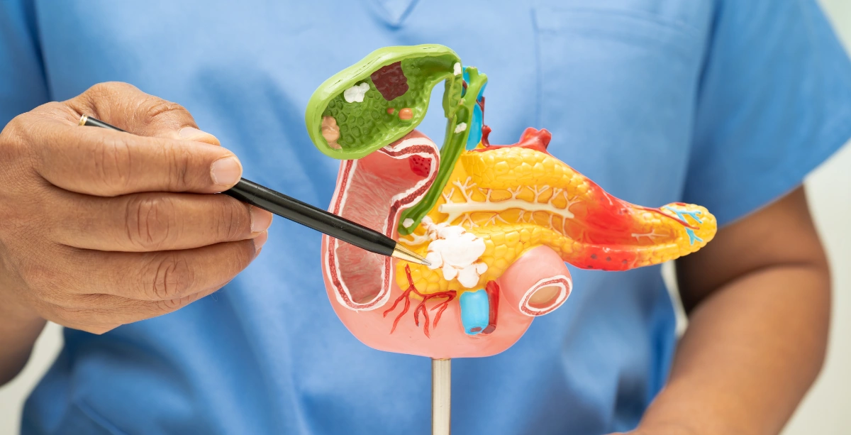 Cálculos biliares: Síntomas, causas y tratamiento